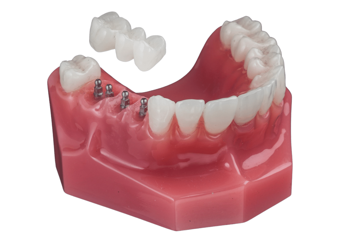 Dental Bridges in Schaumburg, IL | Mini Dental Implant Bridge