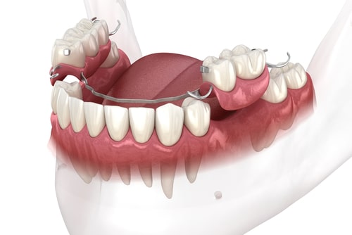 What Are Partial Dentures? | Happy Smiles Family Dentistry